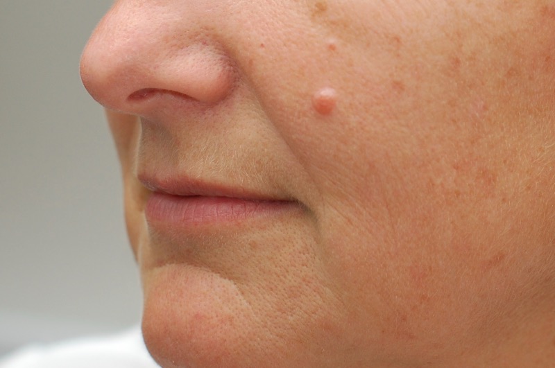 Moles Warts Skin Tags And Benign Growth Treatment Options